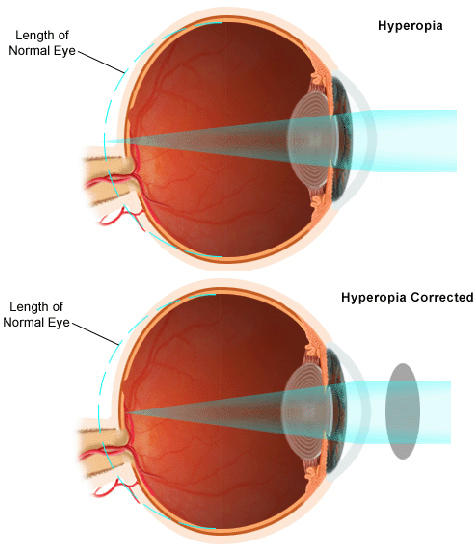 Vision Care - Your Prescription Explained